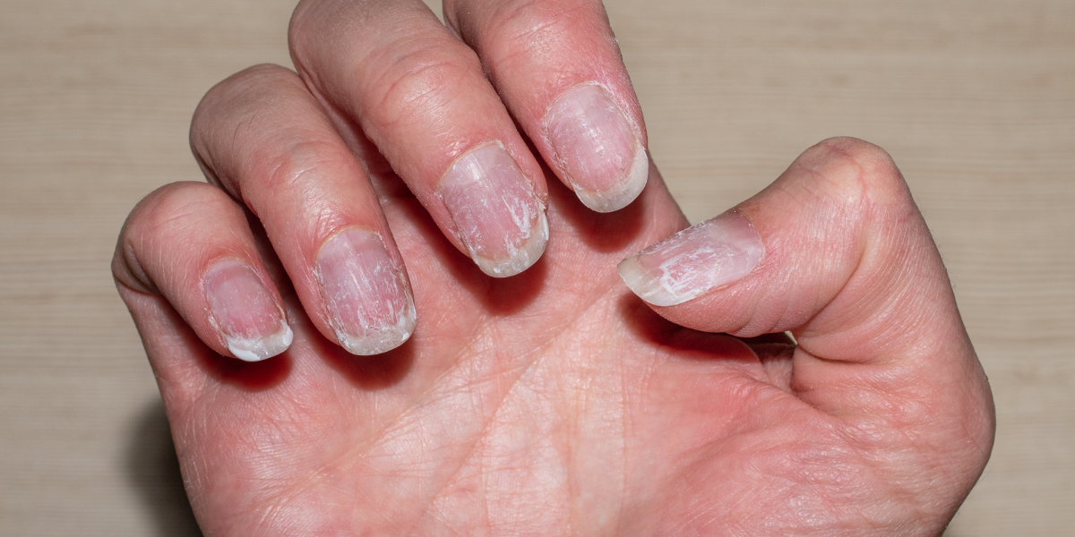 What helps nails grow back faster? – The Positive Company