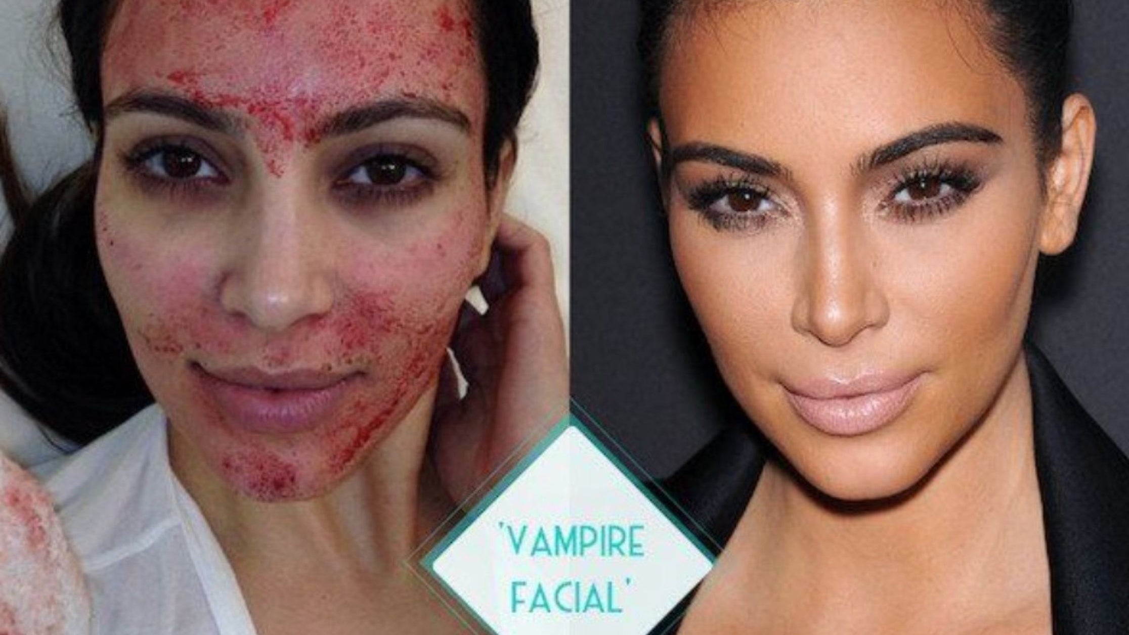 PRP - Vampire facial - Does it work? | The Positive Company